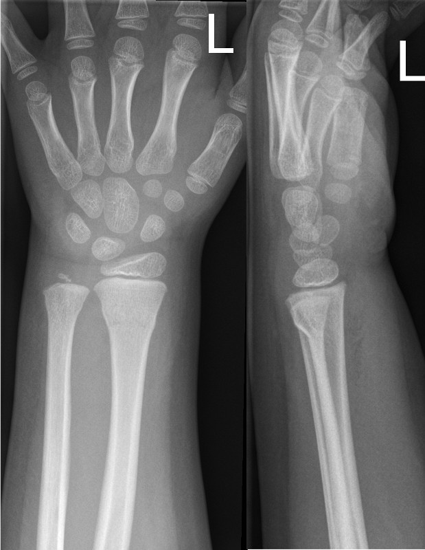 Fractures - Distal forearm or wrist