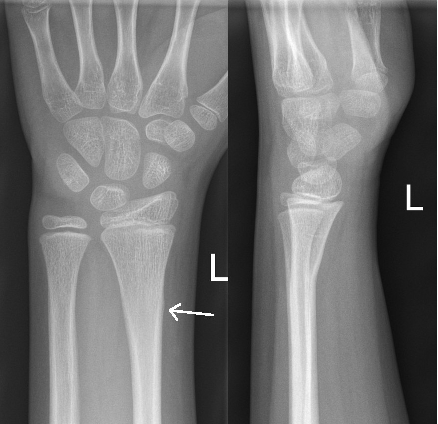 Fractures - Distal forearm or wrist