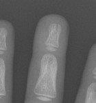 Fractures - Hand