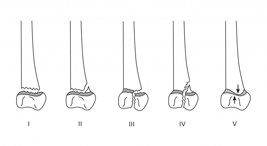 Fractures - Overview