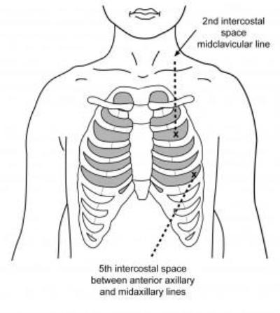 Intercostal Catheters and Needle Thoracocentesis